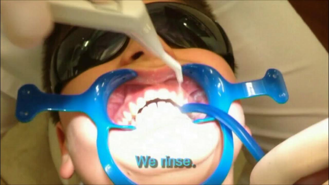 Presenting the Herbst appliance (Part 1) - Tom Nasiopoulos, Specialist Orthodontist - YouTube