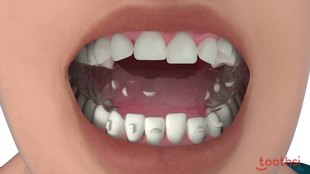 Toothsi Aligner/ Teeth Alignment/ Teeth Straightening / Teeth Gap ...