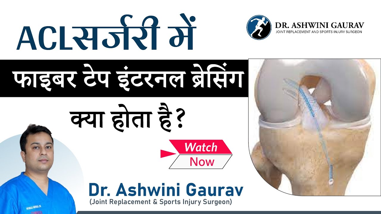 Fiber Tape Internal Bracing In ACL Surgery | ACL Reconstruction In ...