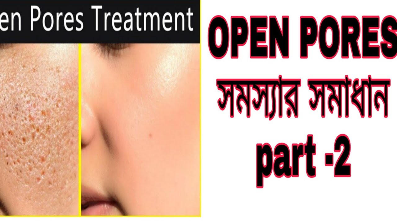 Open pores solution ?? কেন হয়? সমাধান , part -2 / - YouTube