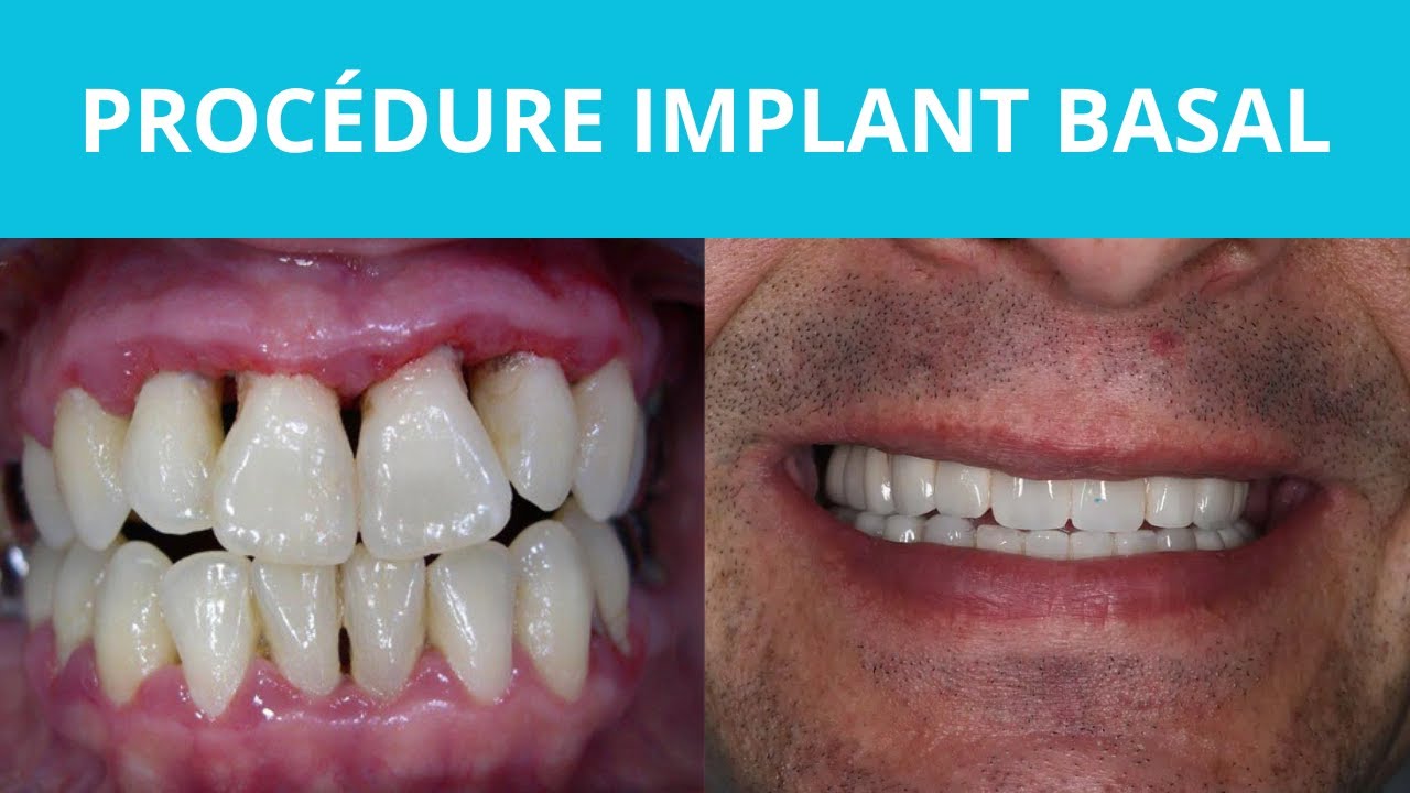 Procédure Implant Basal - YouTube