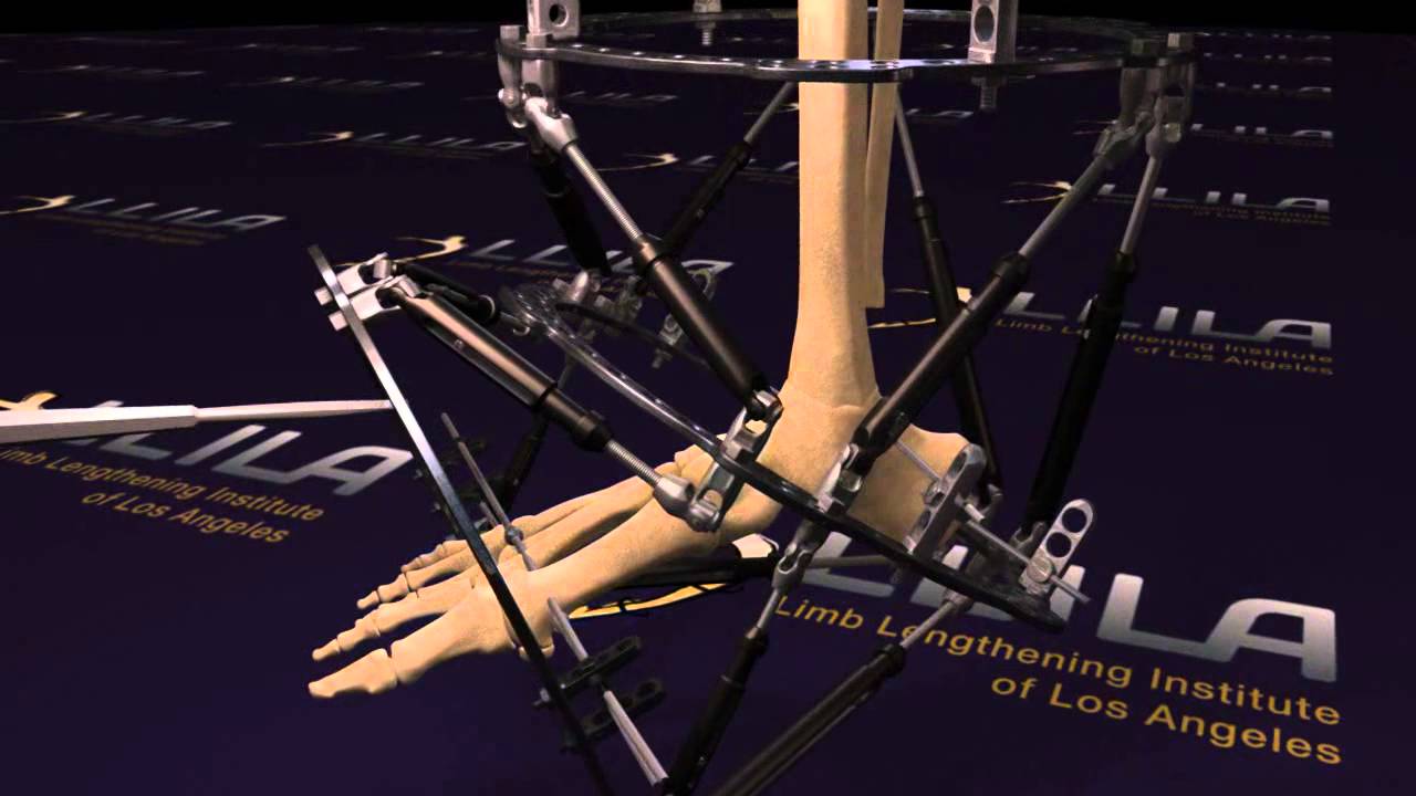External fixation taylor spatial frame for correction of ankle ...