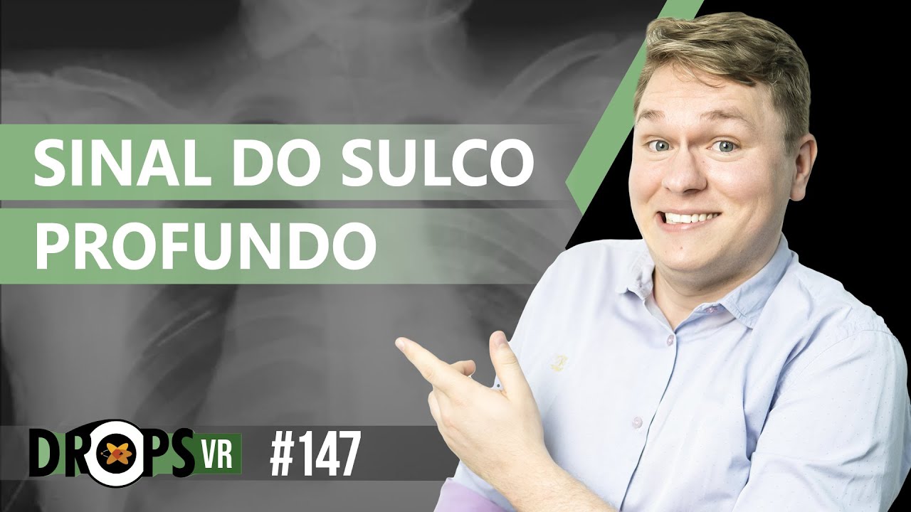 SINAL DO SULCO PROFUNDO - APRENDENDO A IDENTIFICAR NO RX - YouTube