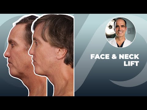 Traceless Face, Neck Lift and CO2 Laser Result - Dr. David Stoker