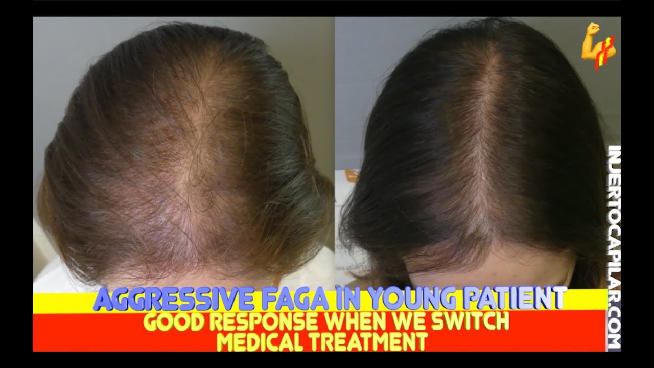 Aggressive FAGA in young patient. Good response when we switch medical ...