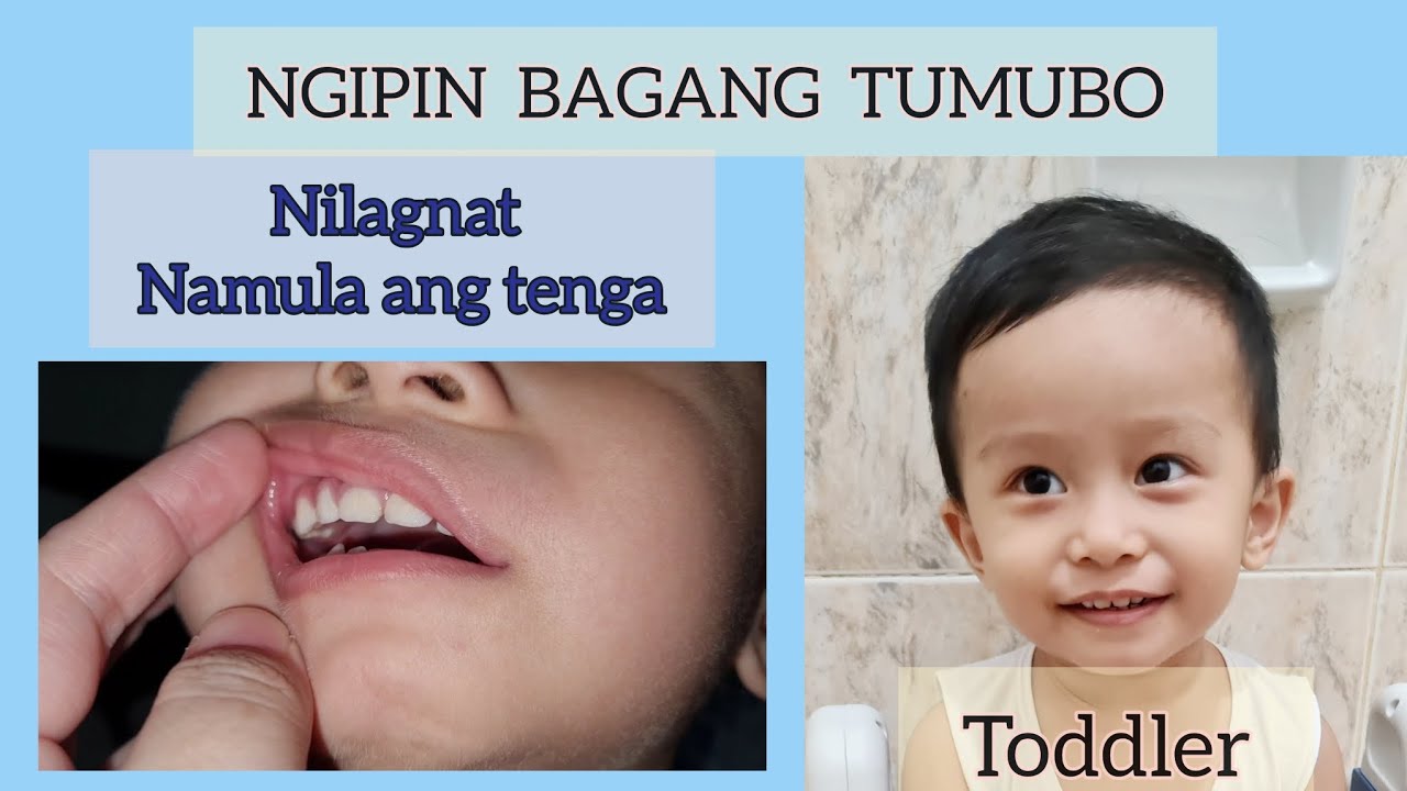 Ngipin Bagang tumubo sa bata | Nilagnat tinutubuan ng bagang | Namula ...