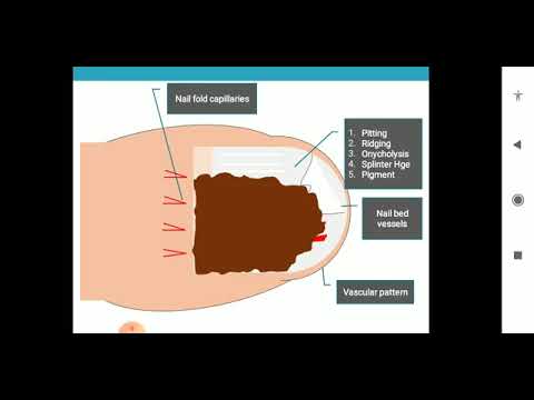 Rania Al Akad Dermoscopy of the nails 1 - YouTube