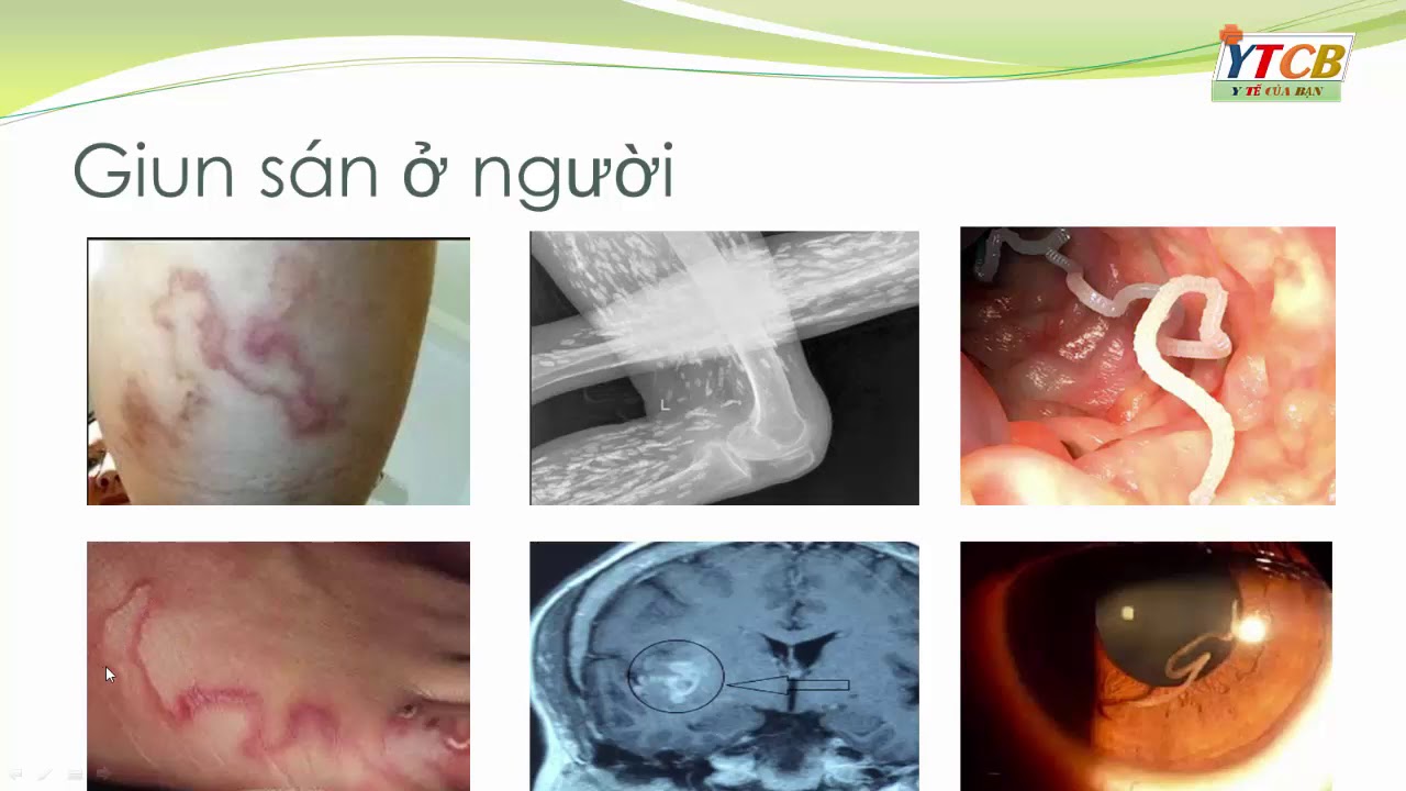 Bệnh sán chó, cách điều trị và bệnh pháp phòng ngừa | bác sĩ kiệt - YouTube