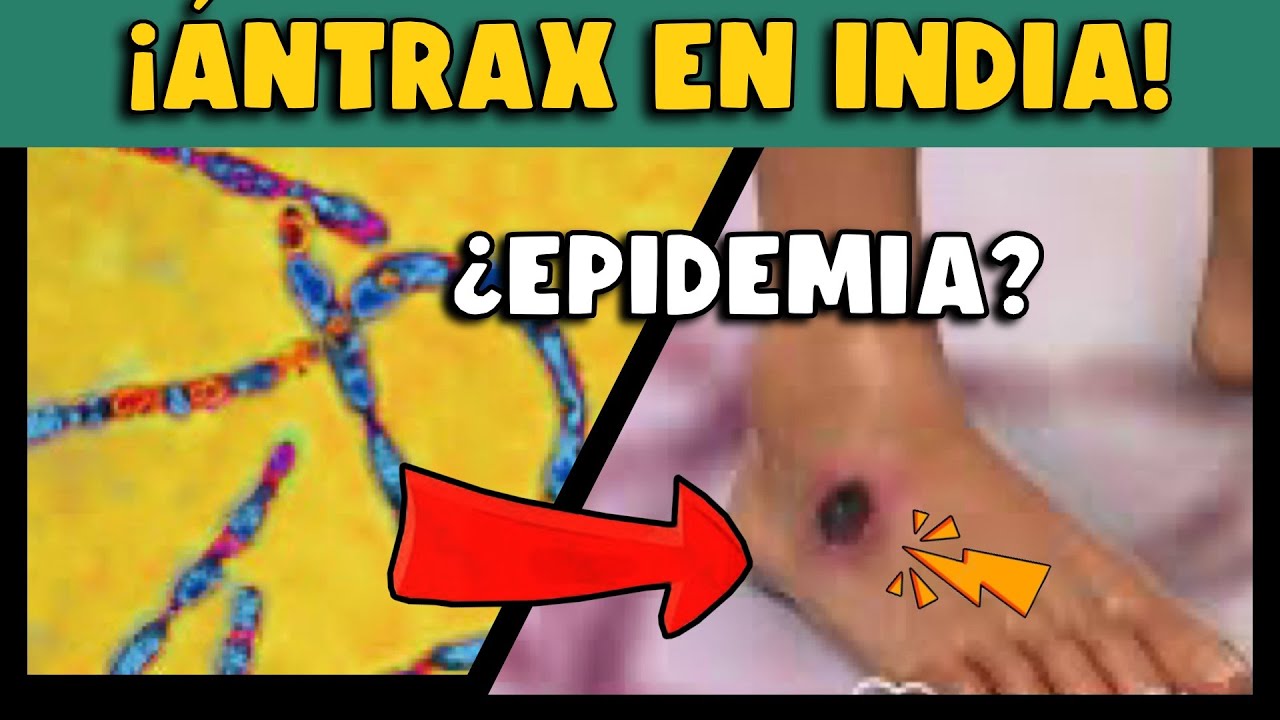 ¡ALERTA! INDIA REPORTA BROTE DE OTRA ENFERMEDAD INFECCIOSA: ANTRAX ¿QUÉ ...