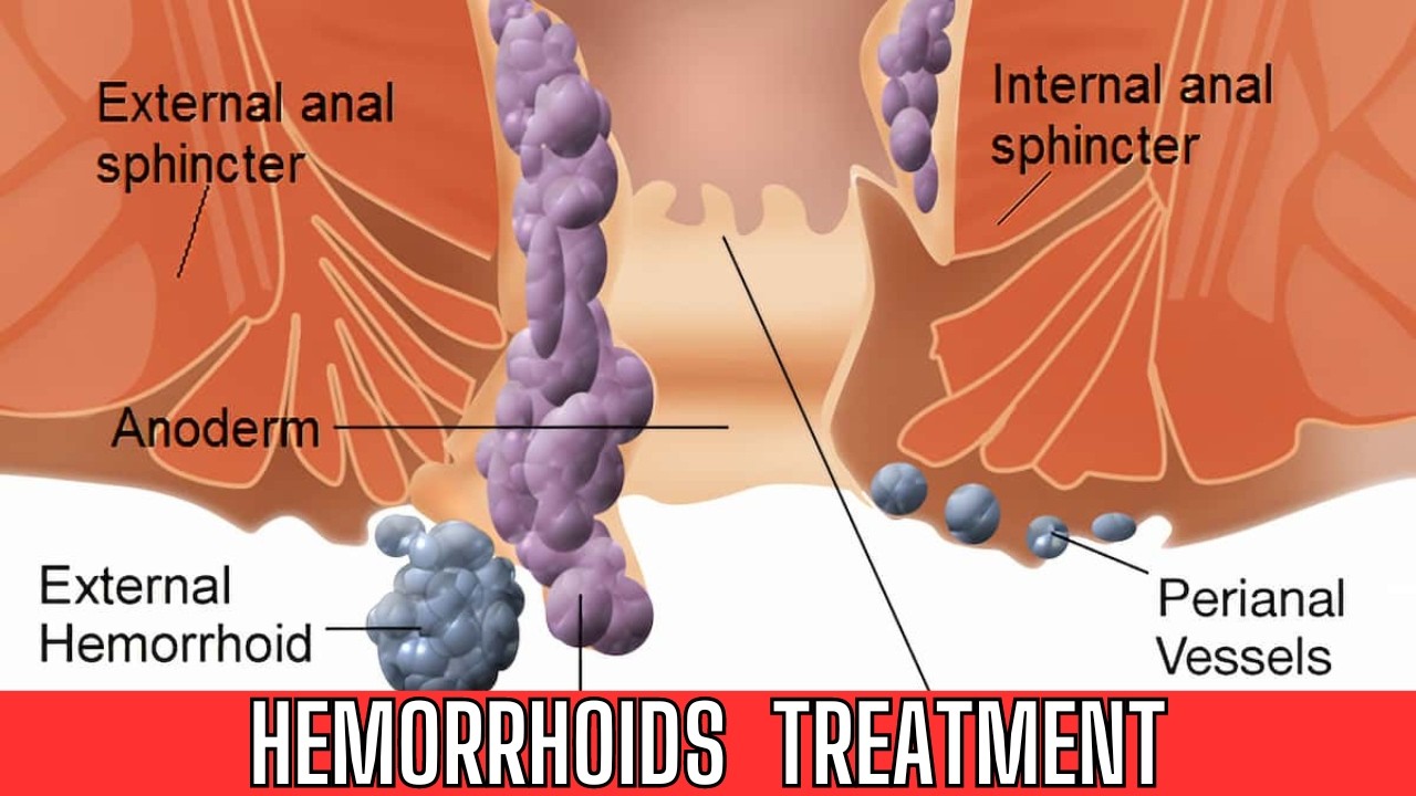Hemorrhoids|different types of hemorrhoids| internal and external ...