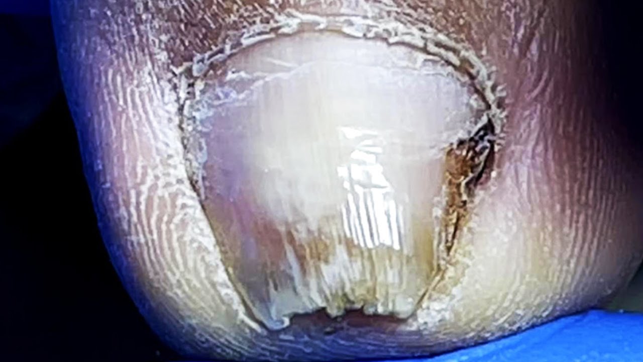 Curly toenails, huge ingrown toenails - YouTube