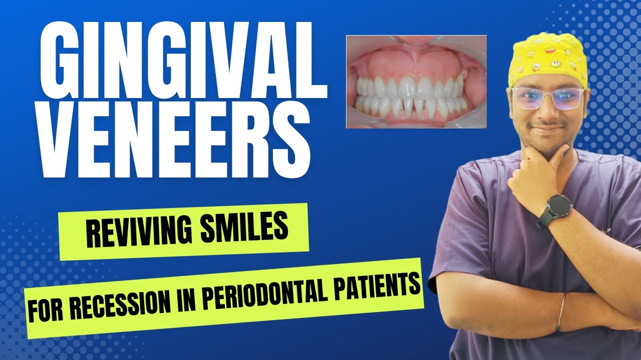 Dr Rudra Mohan | GINGIVAL VENEERS - Reviving Smiles in Periodontal ...