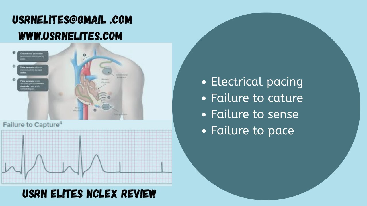 Electrical Pacing Explained - YouTube