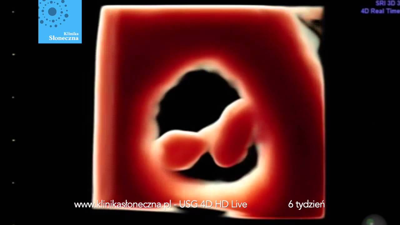 USG 4D HD Live - www.klinikasloneczna.pl Poznań - YouTube