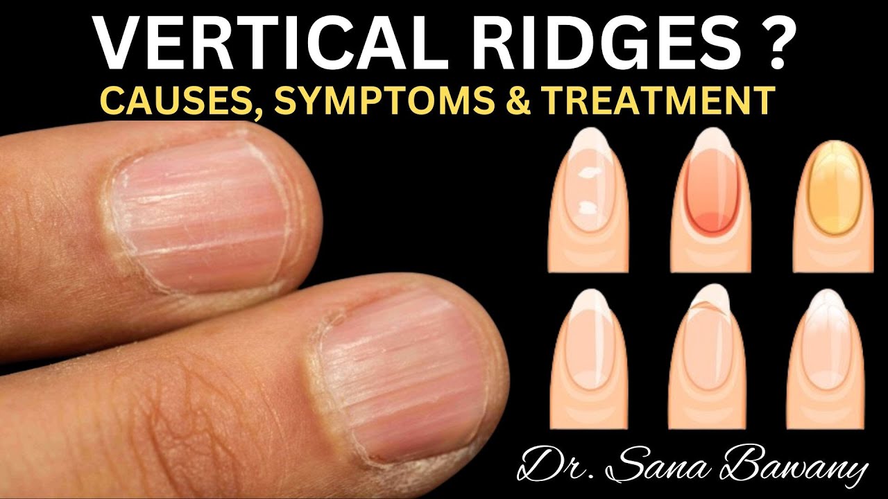 What is Vertical Ridges || Treatment of Vertical Ridges || Home ...