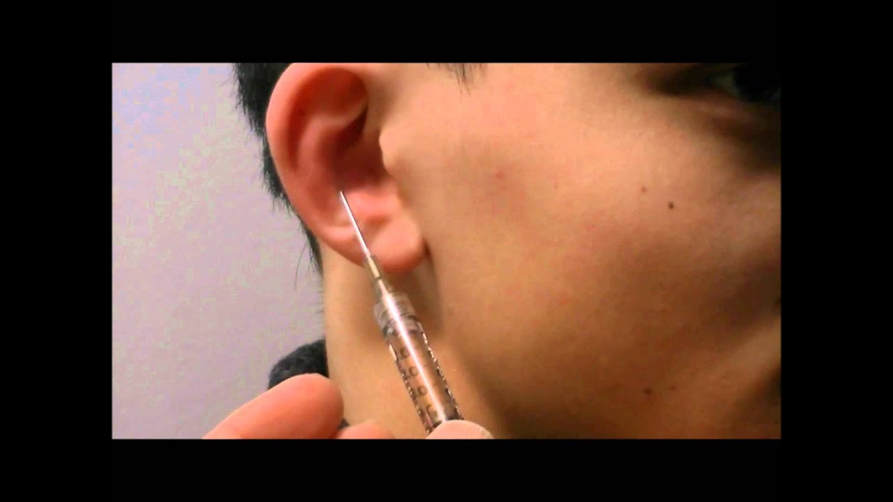 Cauliflower Ear Treatment Youtube