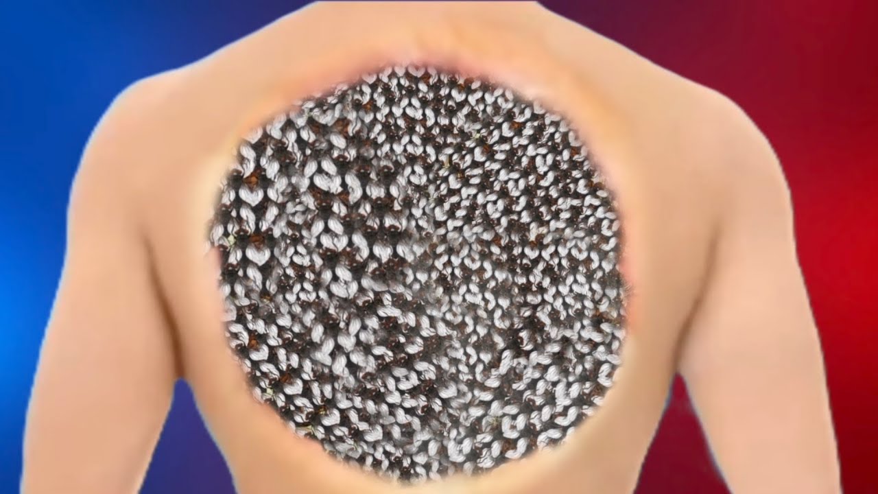 ASMR ANIMATION TREATMENT AND Trypophobia Deep Cleaning From infected ...