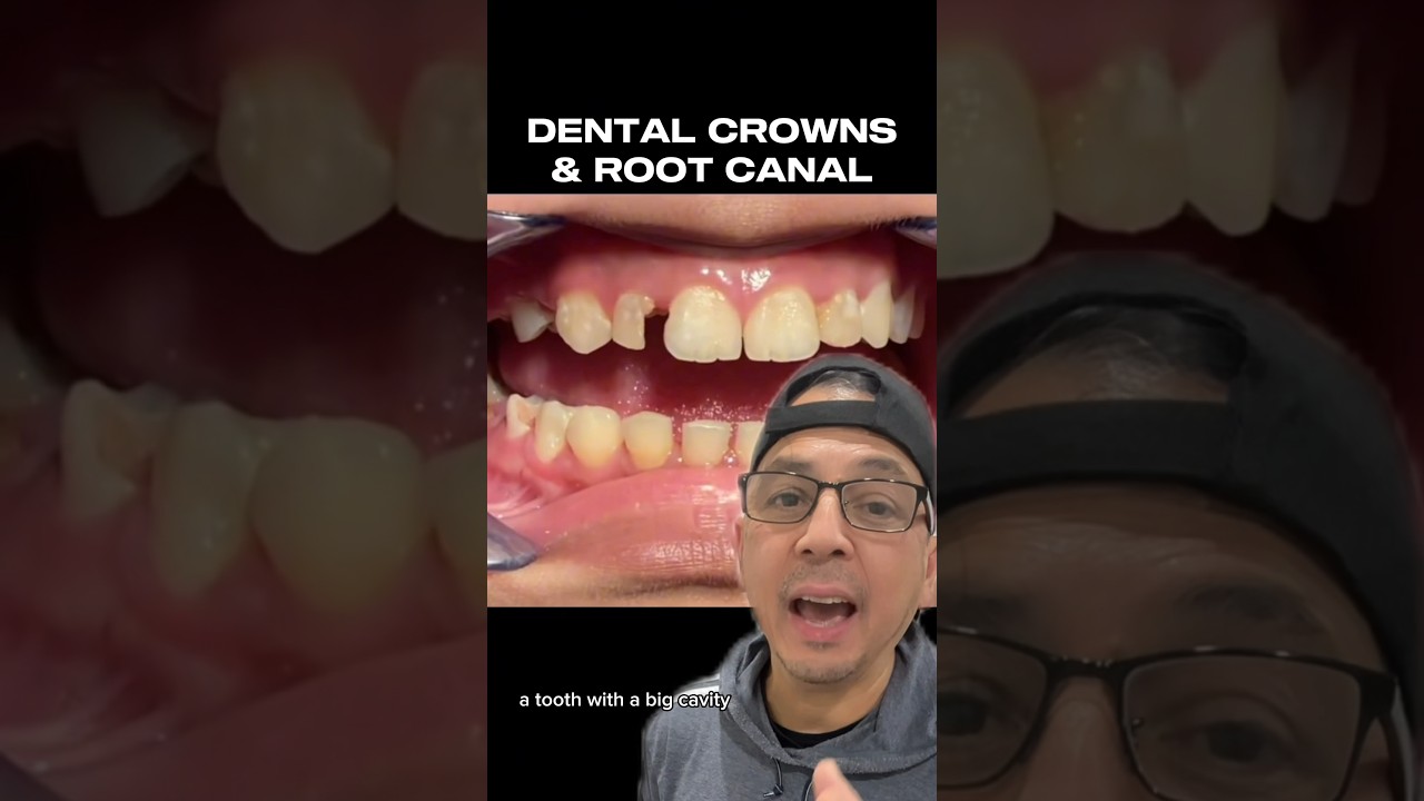 Root Canal on Tooth #7 & Matching Crowns (# 7 & #10) | In Office to ...