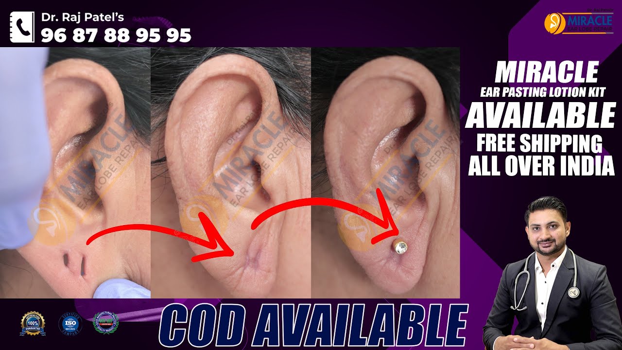 Ear sticking lotion | ear hole repair cream - 9687889595 #earholerepair ...