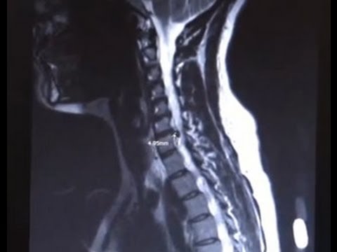Cervical Spine Fusion with Neurosurgeon Dr. Alok Chaudhari - YouTube
