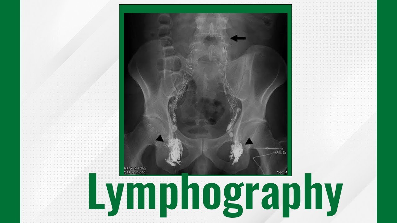Lymphography: Lymphangiography Techniques And Uses? Lymphangiogram ...