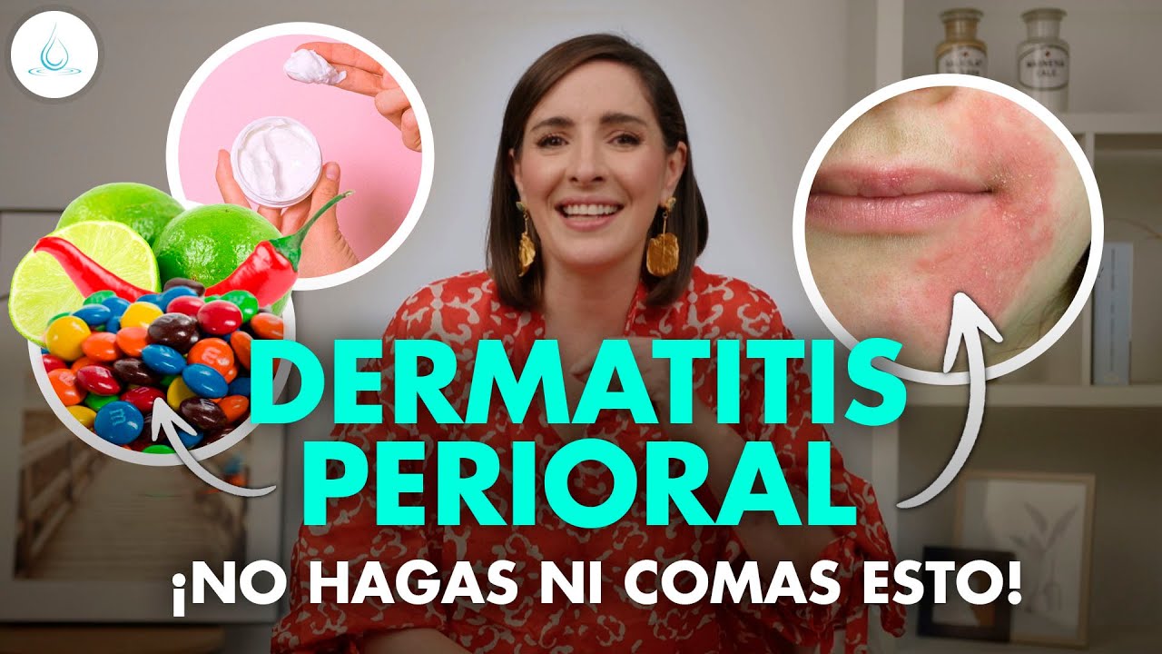 🔴 DERMATITIS PERIORAL ¡GRANITOS o IRRITACIÓN ALREDEDOR de la BOCA ...