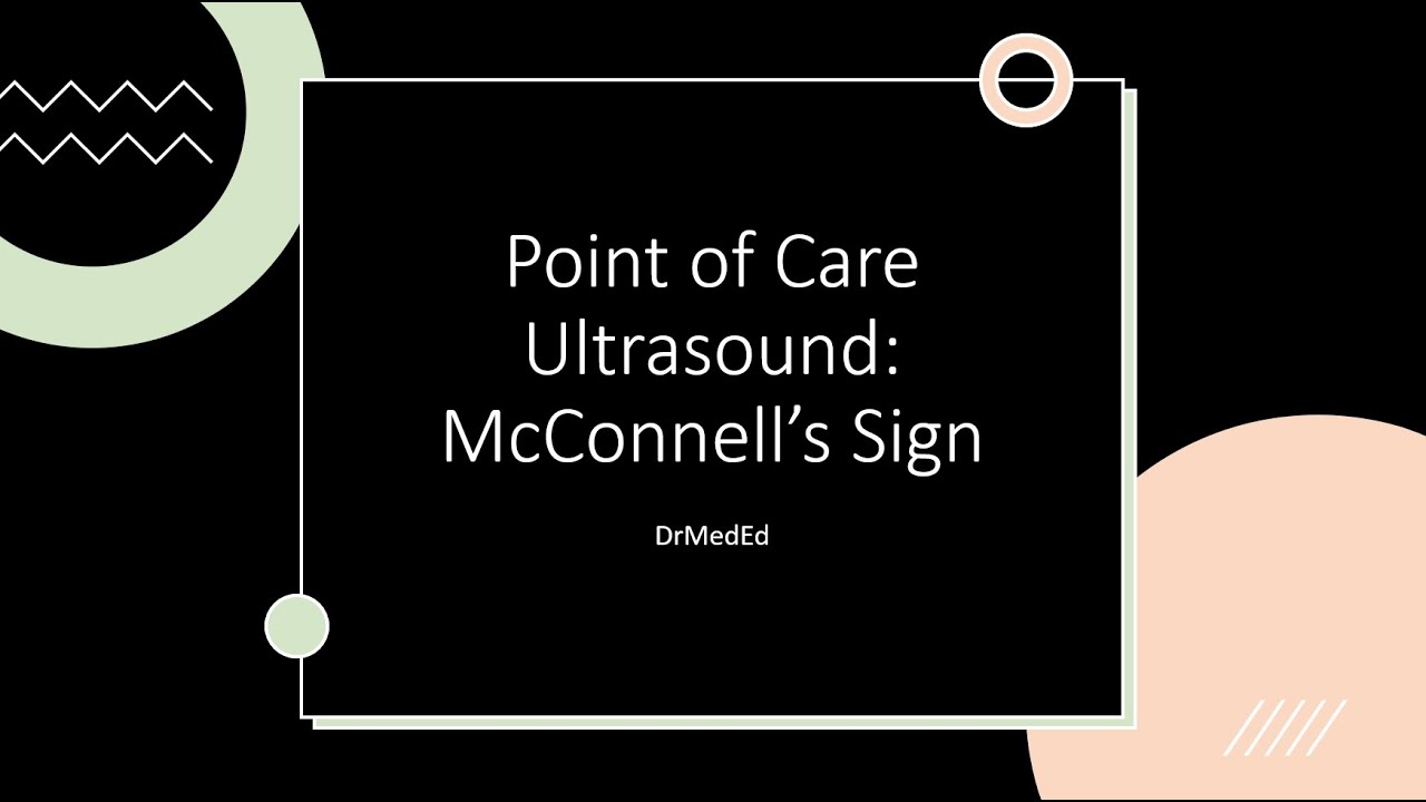 Point of Care Ultrasound (POCUS): McConnell's Sign - YouTube