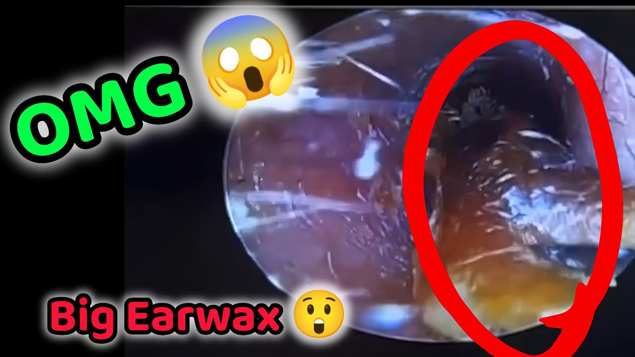 Big Earwax removal /most realistic ear cleaning asmr / ear cleaning ...