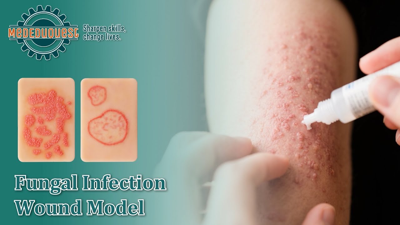 Palm-Sized Fungal Infection Wound Model Set (Set of 2) - YouTube
