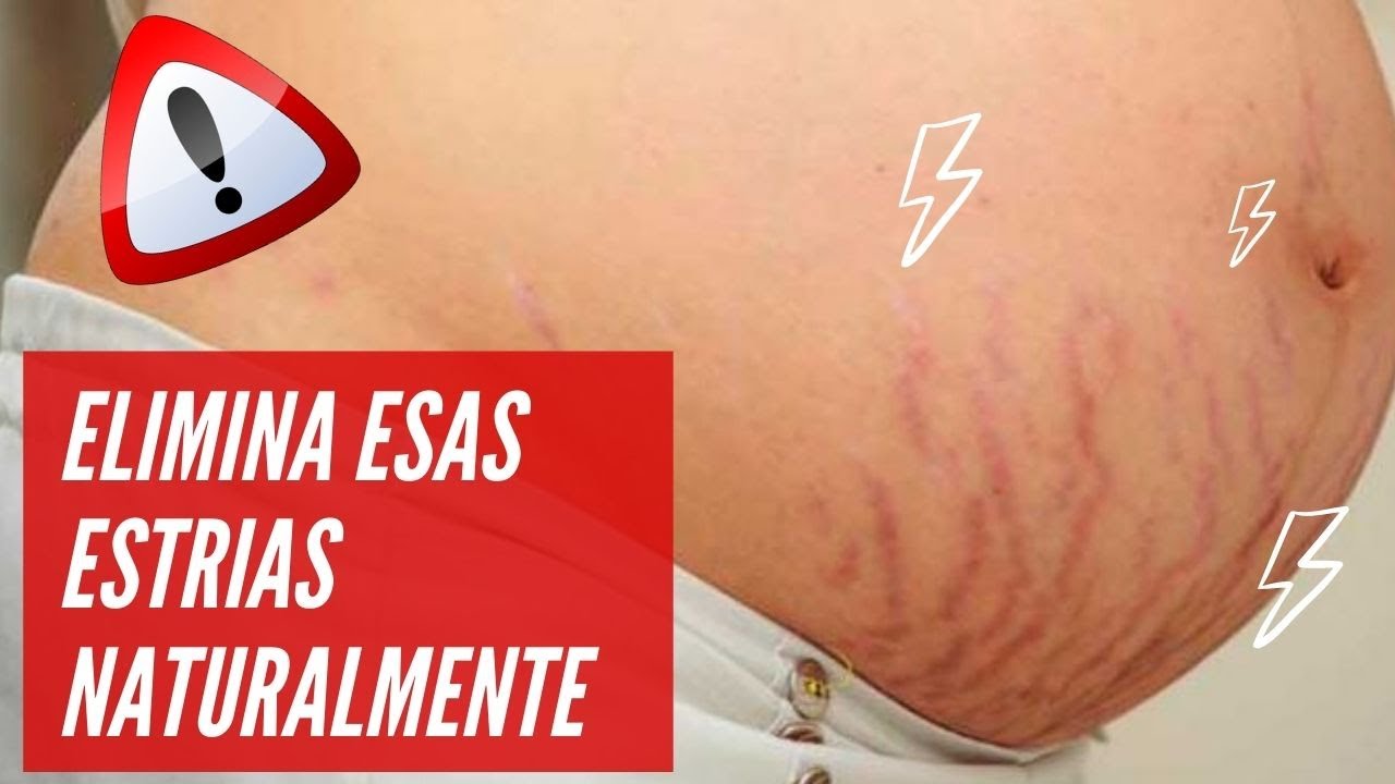 🤰 Como Eliminar las Estrías Rojas del Embarazo - Estoy Embarazada y ...