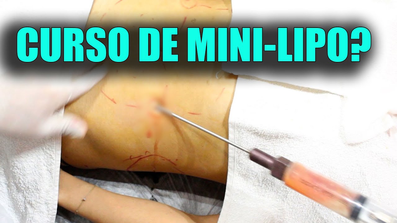 LIPOSUCCIÓN NO QUIRURGICA - MINILIPO - MELA: CURSO 2020 - YouTube