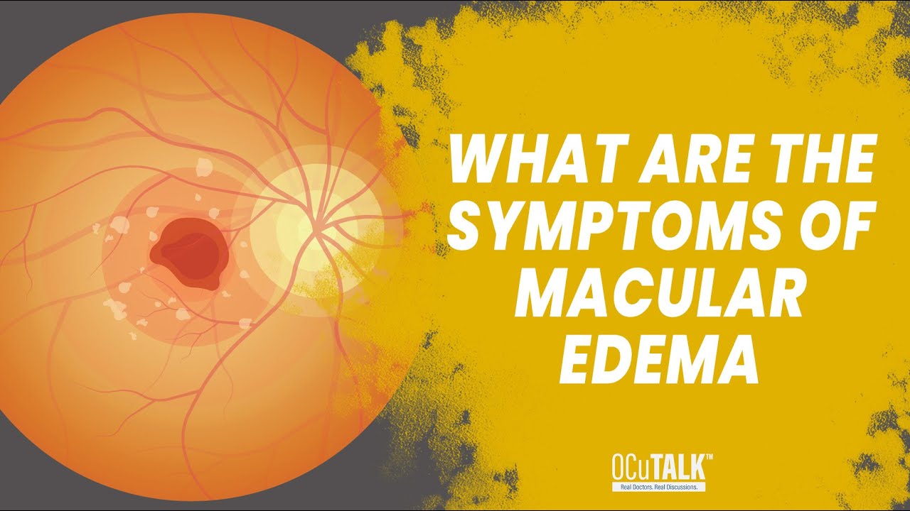 What are the Symptoms of Macular Edema? - Dr. Lazar explains - YouTube
