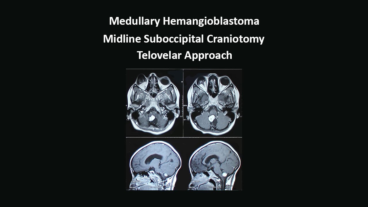 Medullary Hemangioblastoma, MLSOC, Telovelar Approach - YouTube