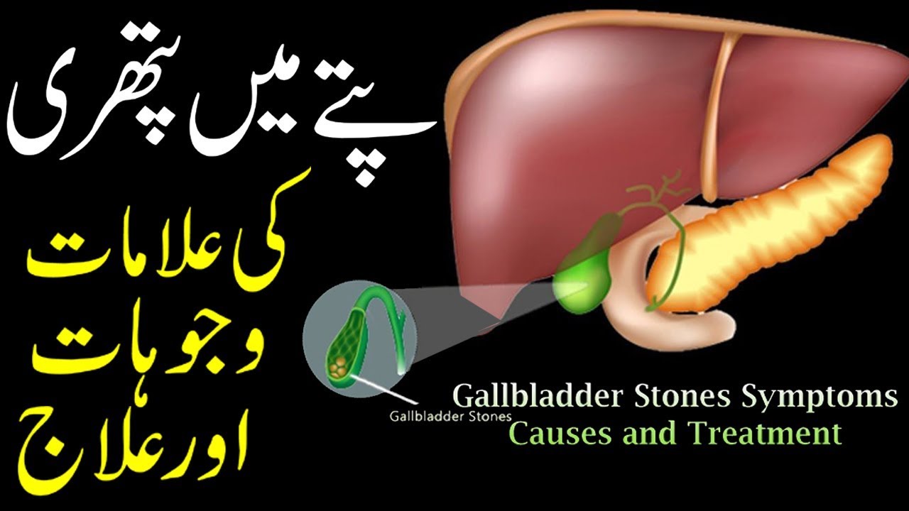 Pity ki pathri ka ilaj | Gallbladder Stones Symptoms Causes and ...