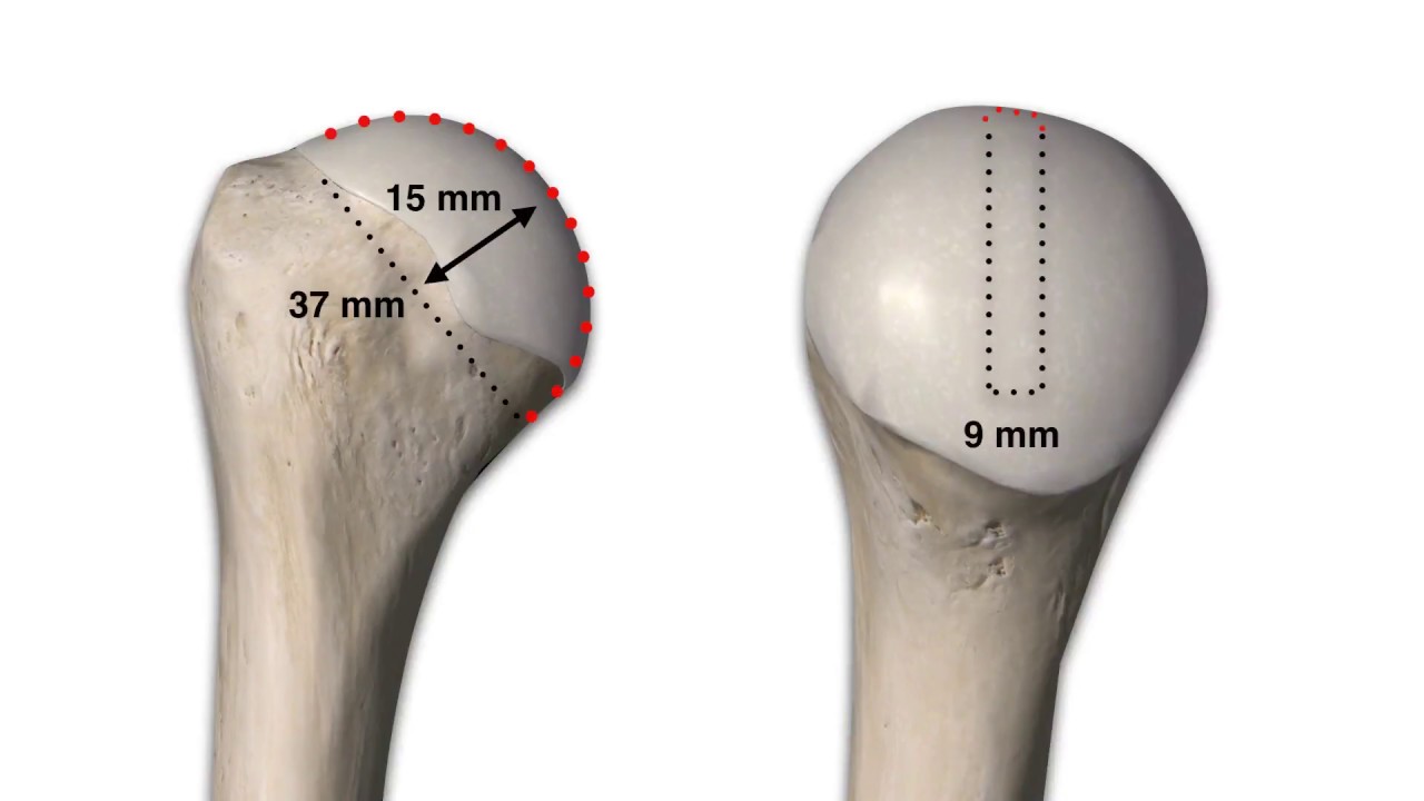 Treatment of Bipolar Bone Loss | Fresh Osteochondral Distal Tibia ...