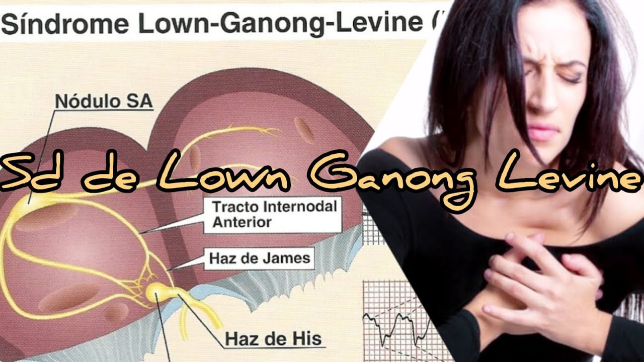CÓMO DIFERENCIAR en eL EKG al SÍNDROME de LOWN GANONG LEVINE - YouTube