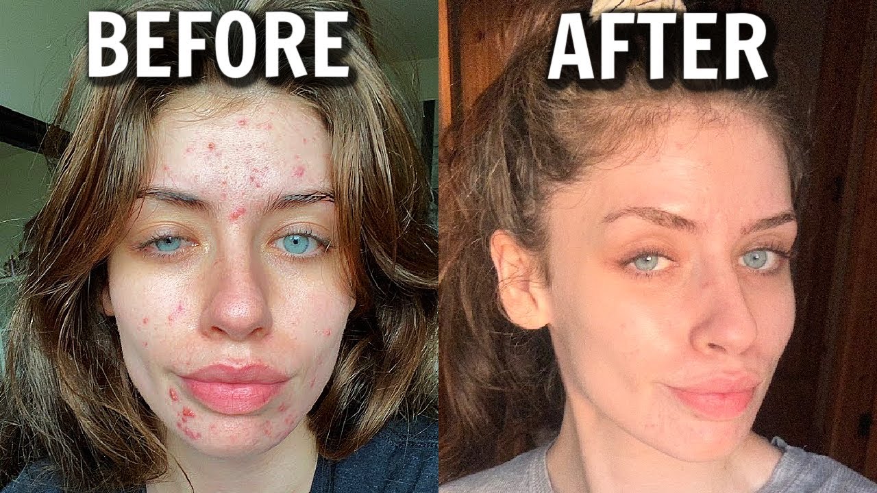 How I finally CLEARED my ACNE for good in 30 DAYS! (& skincare routine ...