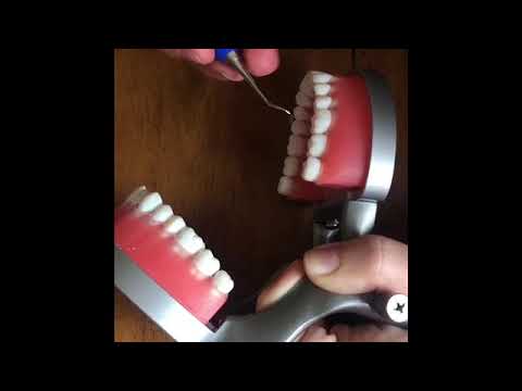 Nevi 3- POSTERIOR SUPRAGINGIVAL ALL SURFACES - YouTube