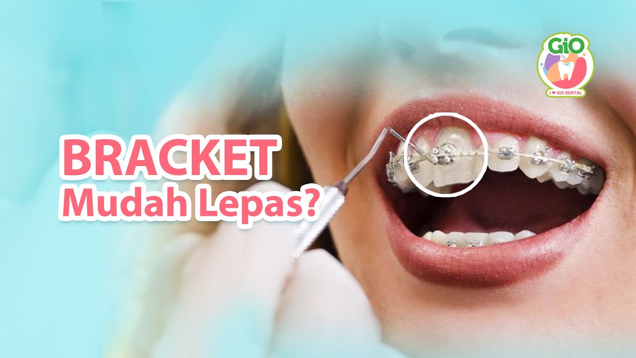 Bracket Mudah Lepas? Ini Penyebabnya | Bracket Easily to Loose? This is ...
