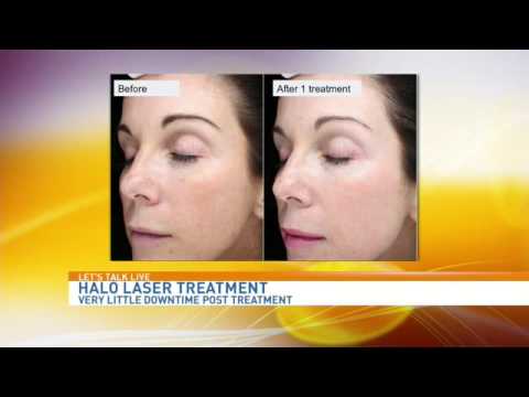Let's Talk Live: Sciton Halo Laser Treatment - Dr. Elizabeth Tanzi ...