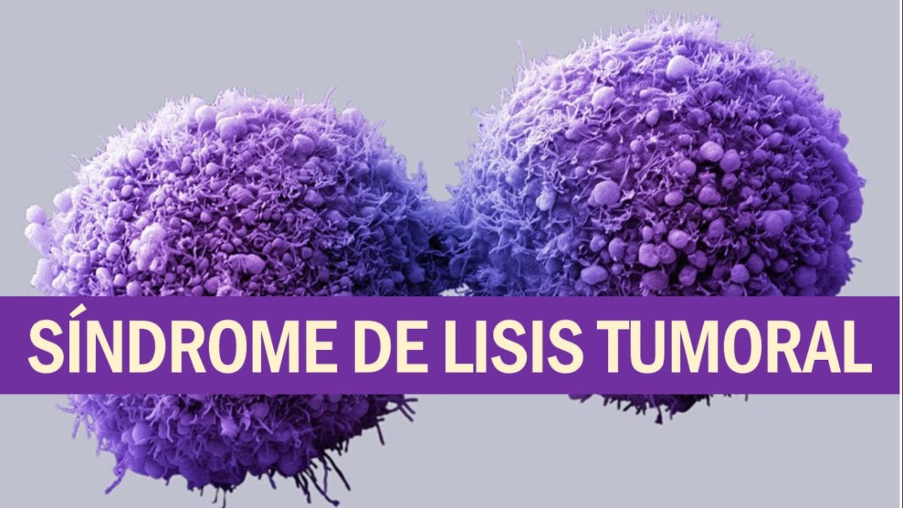 Síndrome de lisis tumoral: Fisiopatología, clínica, diagnóstico y tratamiento - YouTube