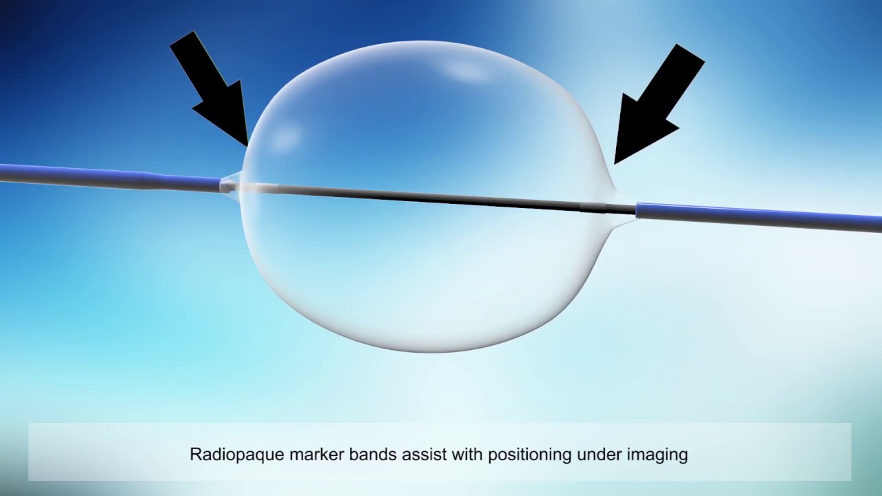 ER-REBOA™ Catheter and procedure review - YouTube