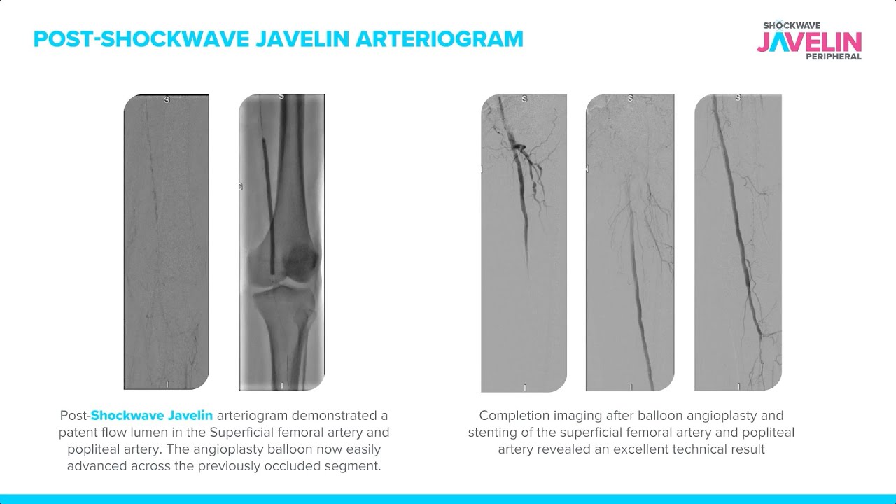 Shockwave Javelin: SFA Occlusion Case Review with Dr. Foley - YouTube