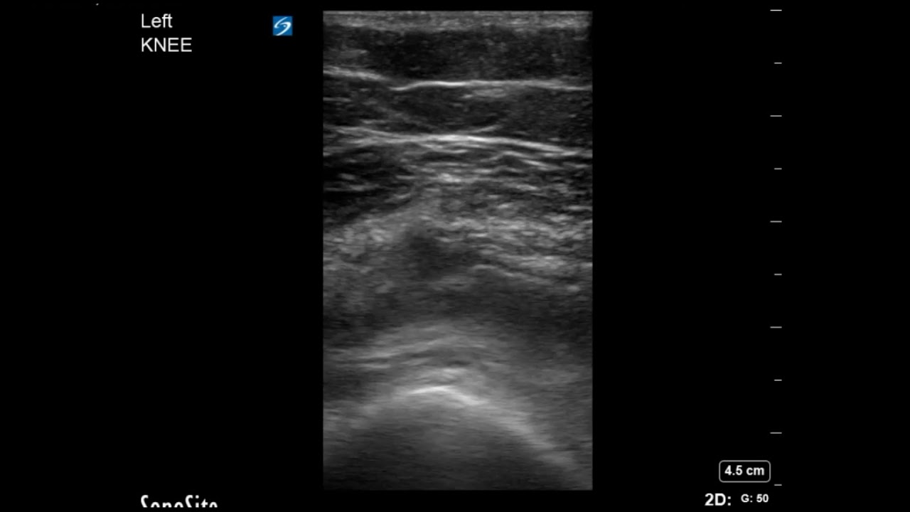 Knee Ultrasound: Suprapatellar Bursa, No effusion (Part 1) - YouTube