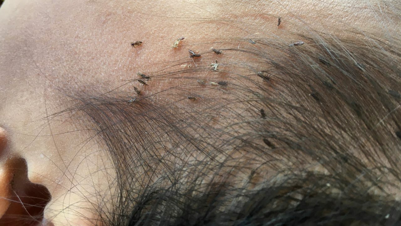 How to get rid of head lice naturally - Head lice removal from long ...