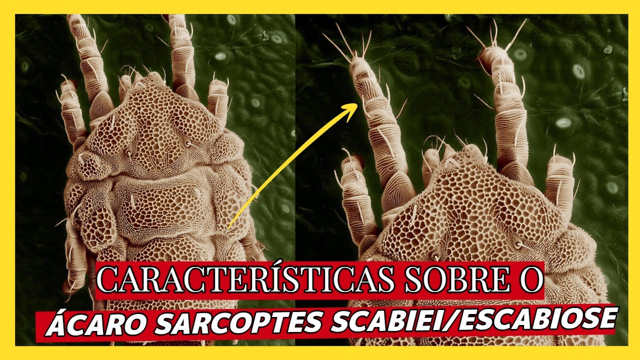 CARACTERÍSTICAS DO ÁCARO SARCOPTES SCABIEI QUE É O CAUSADOR DA ...