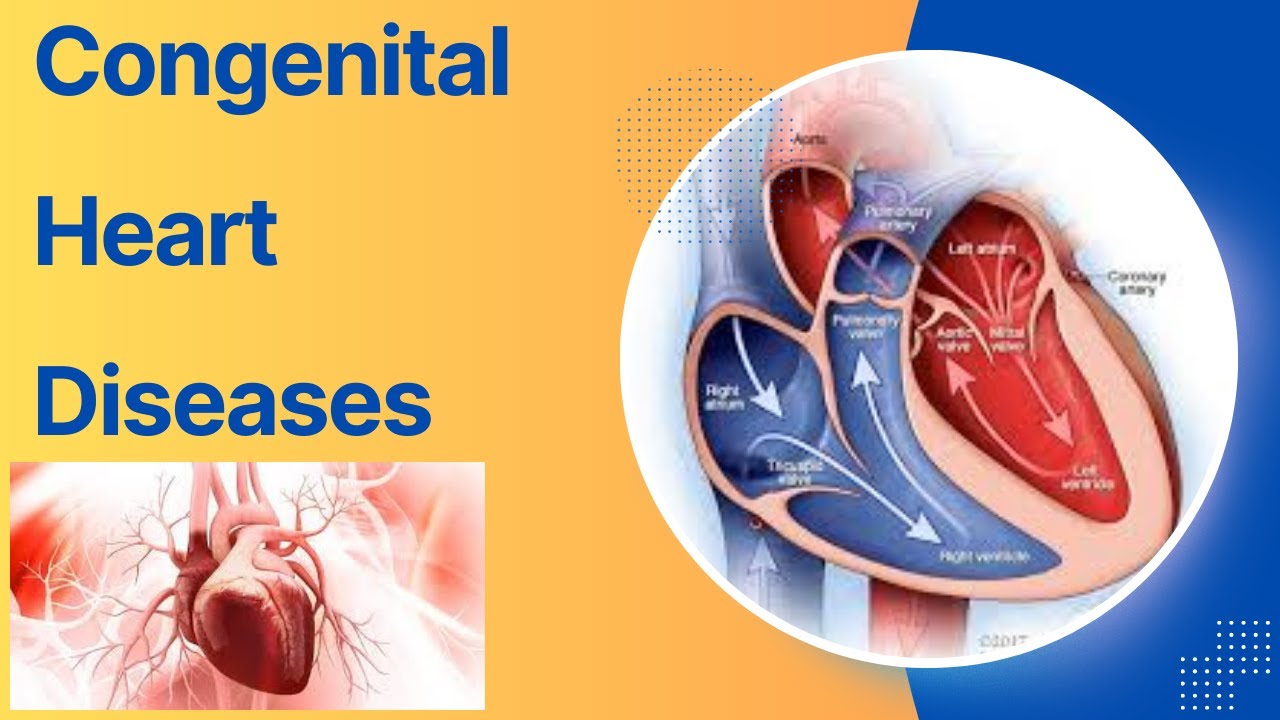 Congenital Heart Diseases | Congenital Heart Defects | Complex ...