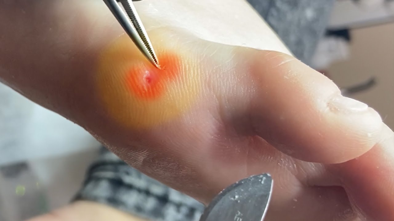 Pedicure tutorials - Two corns were hiding under the corns! - YouTube