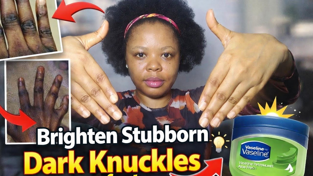 How To Brighten Stubborn Dark Knuckles Caused By Bleaching Creams - YouTube