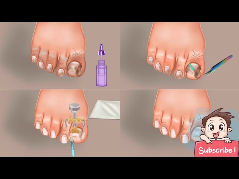 Ingrown Toenail asmr [ASMR INGROWN TOENAIL ANIMATION] - YouTube